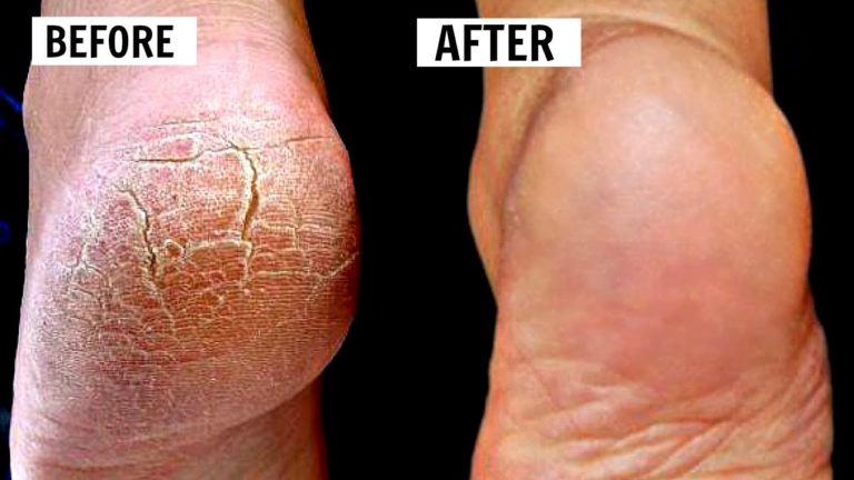 Cracked Heels Treatment |Step By Step Footcare
